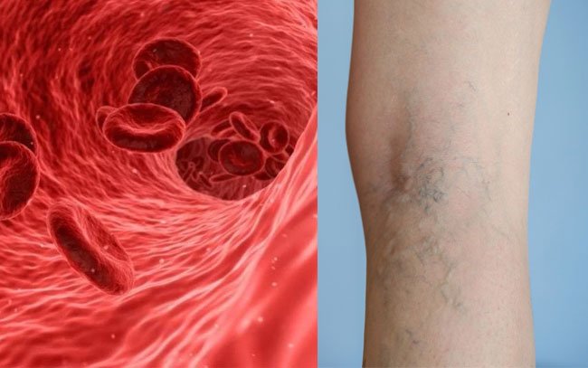 Por qué salen las varices y cómo prevenirlas-Primera Vuelta